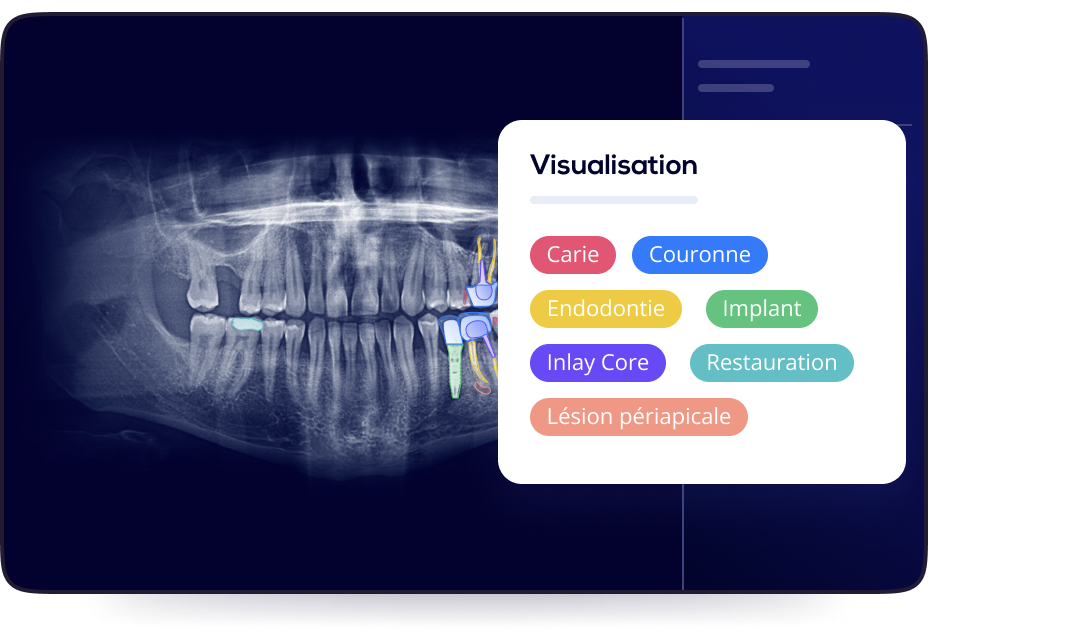 Allisone - El software para explicar sus radiografías dentales